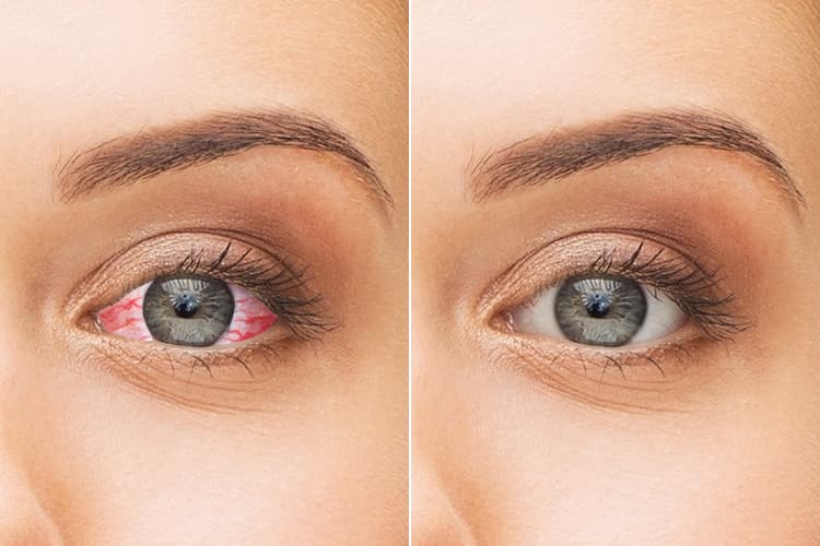 Dry Eye Syndrome 10 Home Remedies To Cure It YeyeLife