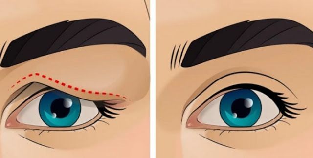 Best Natural Home Remedies For Drooping And Sagging Eyelids - YeyeLife