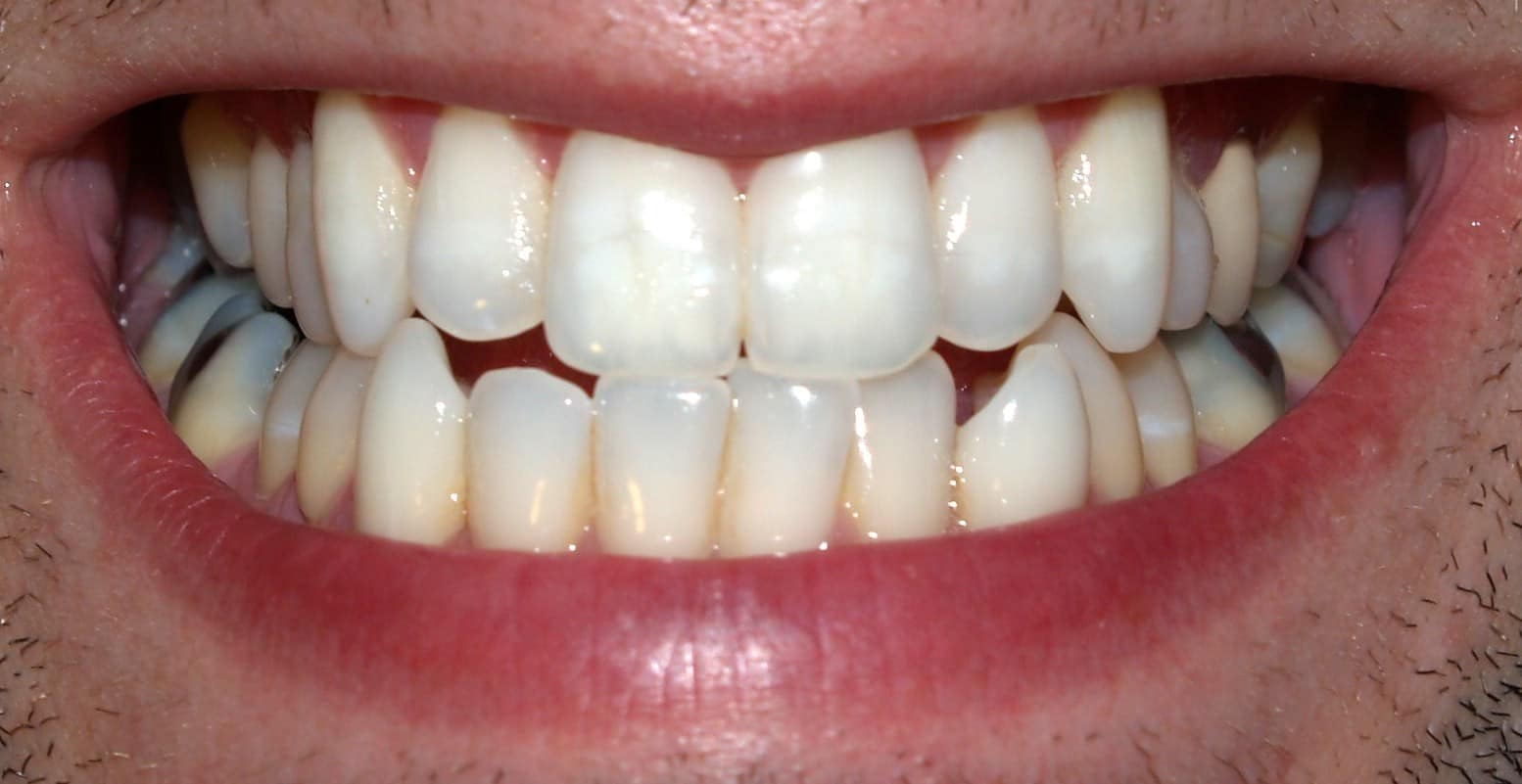 White Gums Around The Teeth: Causes and Treatment - YeyeLife