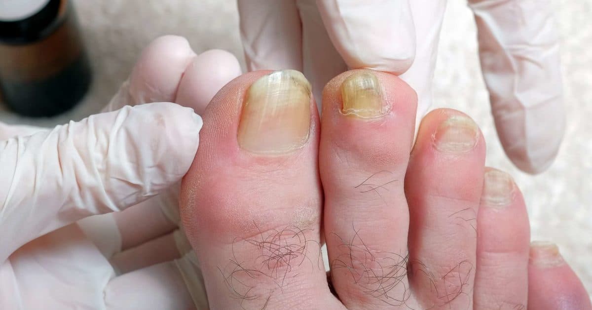 How To Get Rid Of Yellow Toenails Fast With Home Remedies YeyeLife How To Get Rid Of Yellow Toenails Fast With Home Remedies YeyeLife