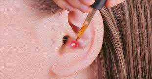 How To Get Rid Of a Pimple In Your Ear Fast: A Detailed Guide - YeyeLife